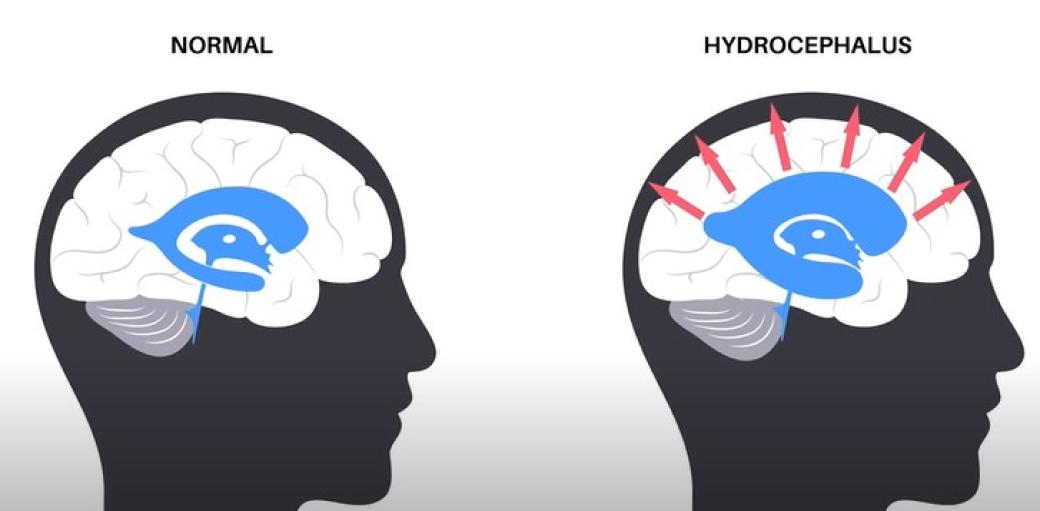 Reflections on Billy Joel's Normal Pressure Adult Hydrocephalus ...