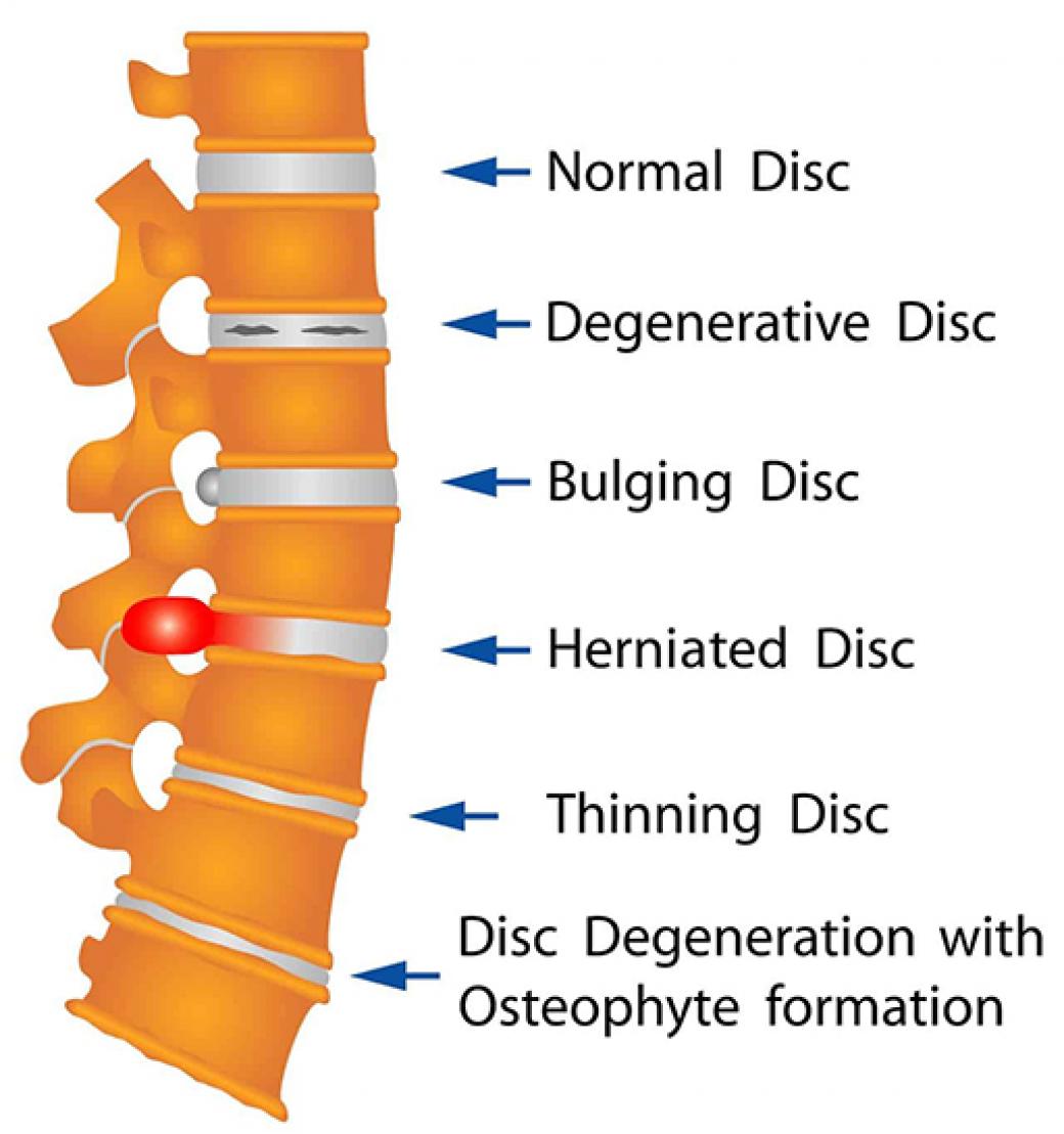 Degenerative Disc Disease Diagnosis & Treatment - NYC | Columbia ...