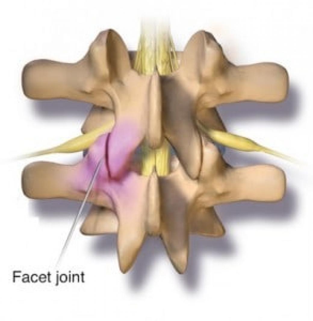 Synovial Cyst Diagnosis & Treatment - NYC | Columbia Neurosurgery in ...
