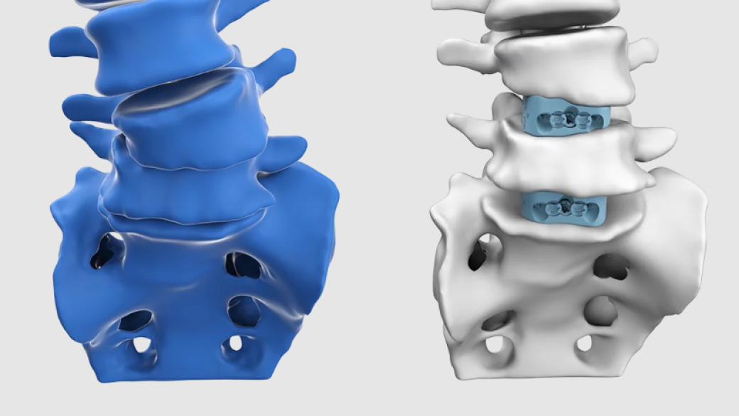 Minimally Invasive Spinal Fusion: Thoracic And Lumbar - NYC | Columbia ...