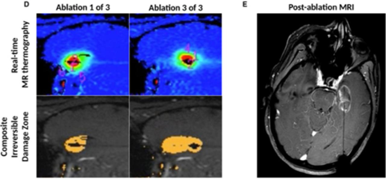 Long-term Outcomes of Laser Ablation Therapy for Drug-Resistant ...