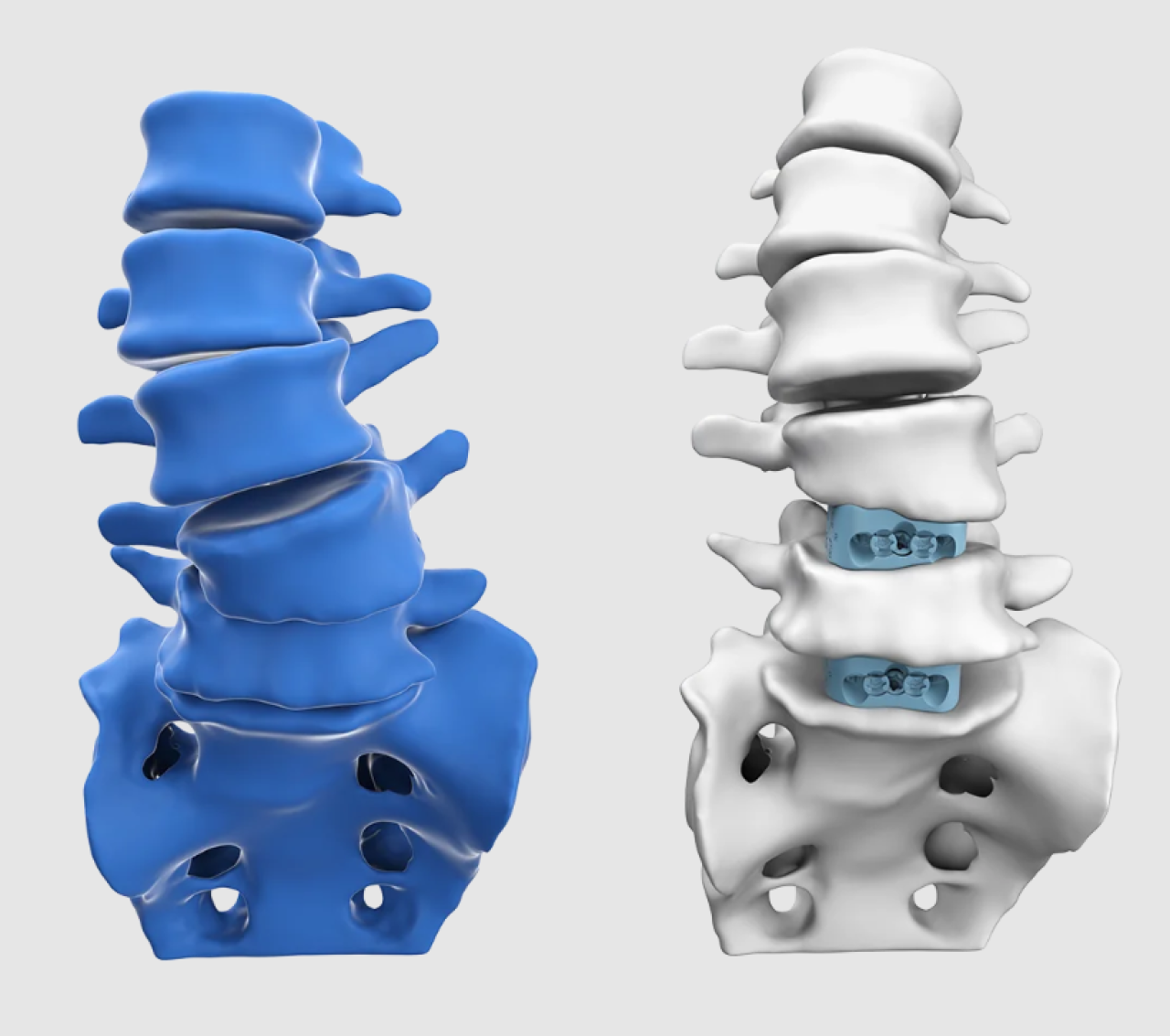 AI Paving the Way for Personalized Spine Implants | Columbia ...