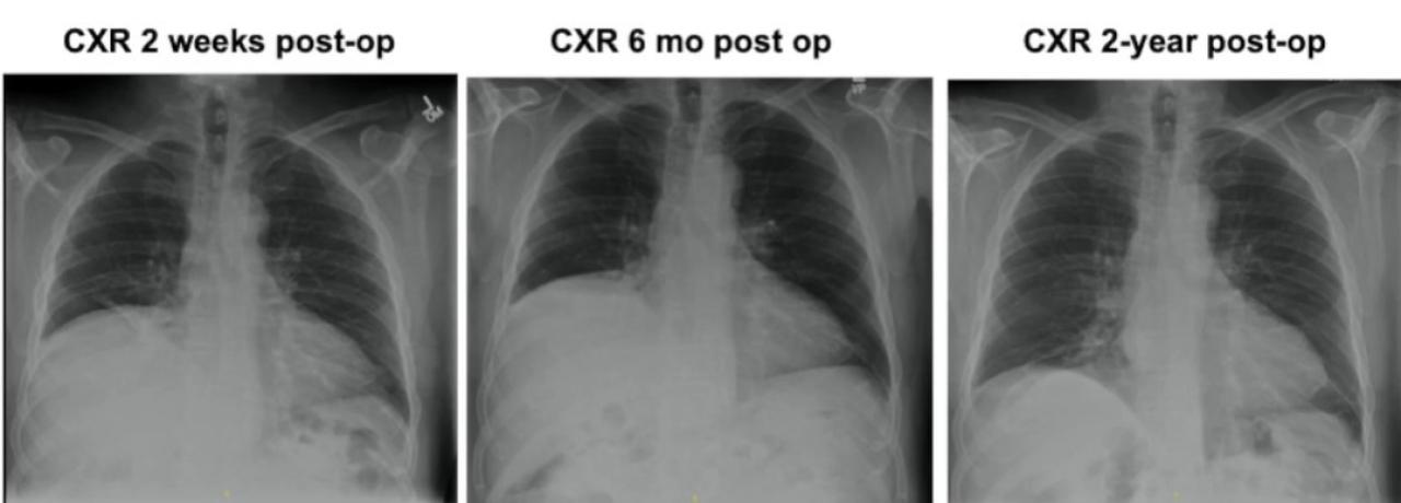 Dr. Chris Winfree Treats Parsonage-Turner Syndrome with a Phrenic Nerve ...