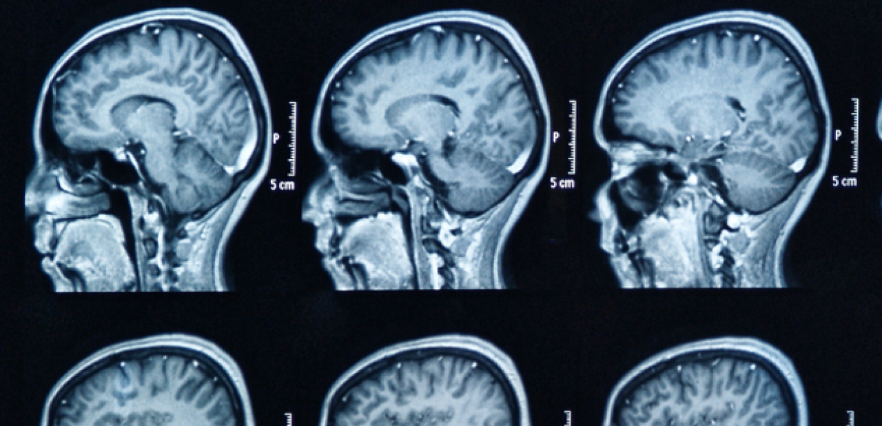 Neurosurgery and Radiology: The Role of the Neuroradiologist | Columbia ...