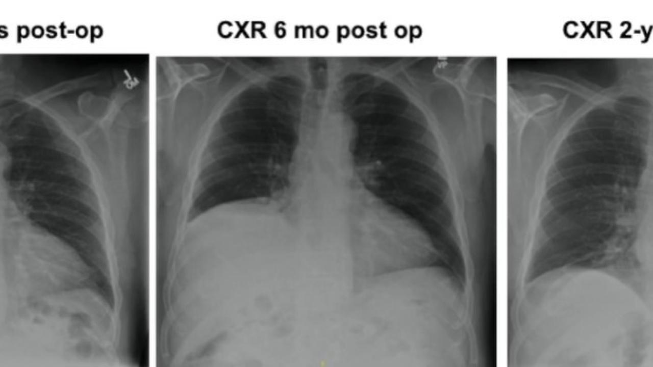 Dr. Chris Winfree Treats Parsonage-Turner Syndrome with a Phrenic Nerve ...