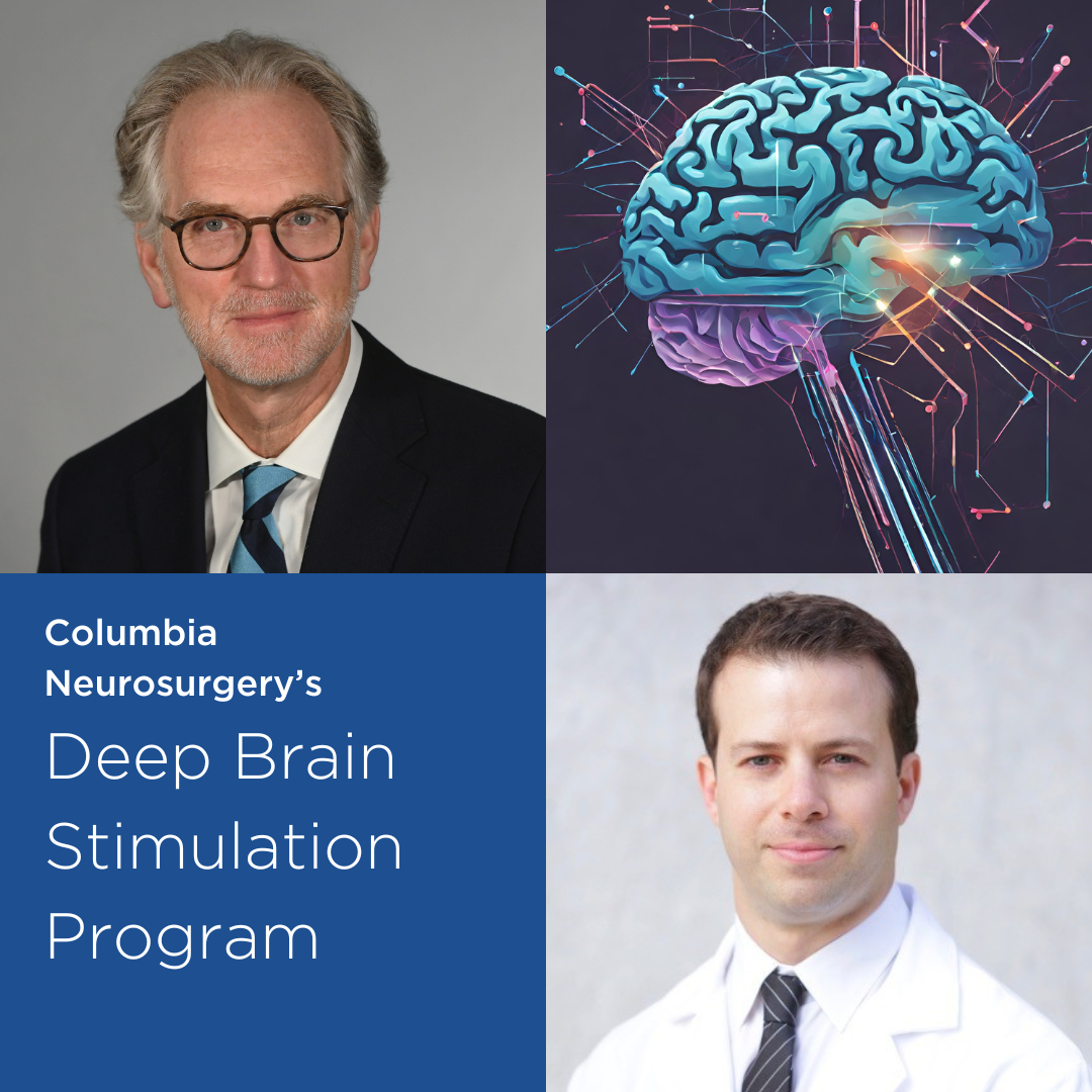 Offering Asleep, Single-Stage Deep Brain Stimulation (DBS) | Columbia ...