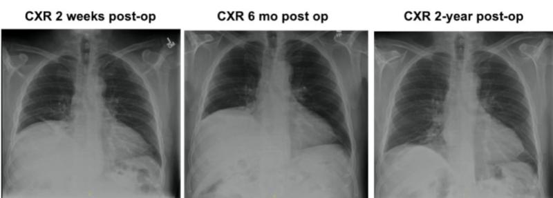 Dr. Chris Winfree Treats Parsonage-Turner Syndrome with a Phrenic Nerve ...