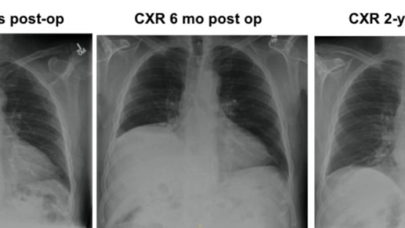 Neuralgic Amyotrophy / Parsonage-Turner Syndrome | Columbia ...