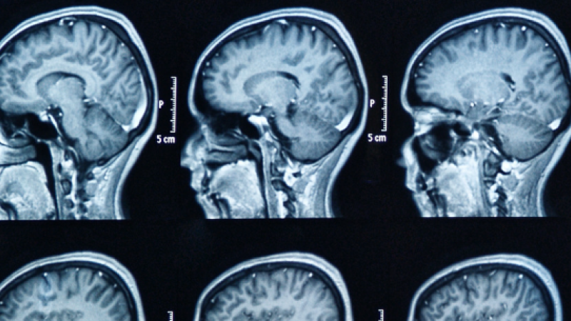 Atypical Facial Pain Diagnosis & Treatment - NYC | Columbia ...